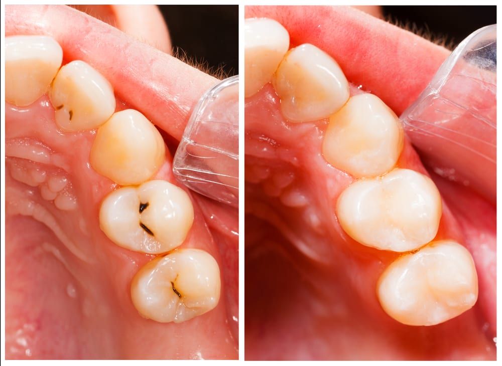 Composite Tooth-Colored Fillings » Middletown, NJ Dentistry - Dr ...